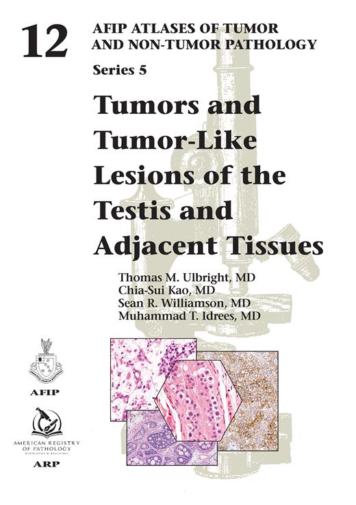 Mixed Germ Cell Sex Cord Stromal Tumors Tumors And Tumor Like Lesions